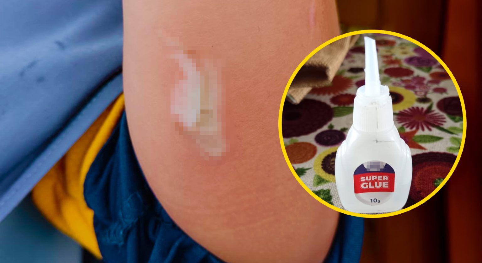 Murid melecur pada kulit akibat terkena Super Glue di sekolah | The ...