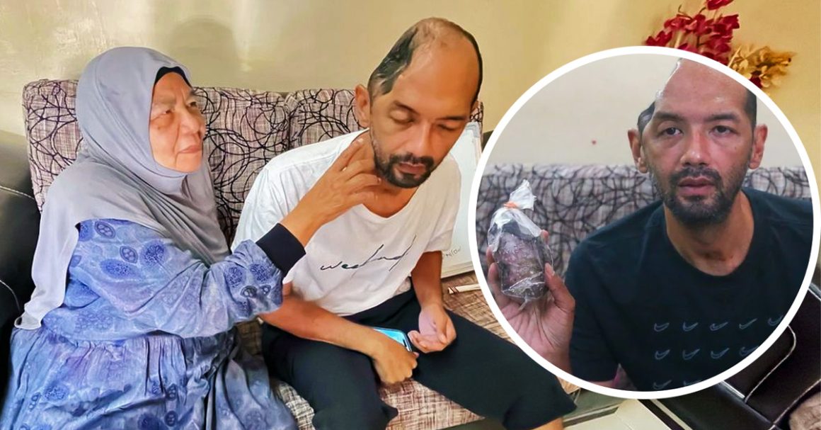 'Sejak tempurung kepala tinggal separuh, ramai rakan jauhkan diri' | The Reporter